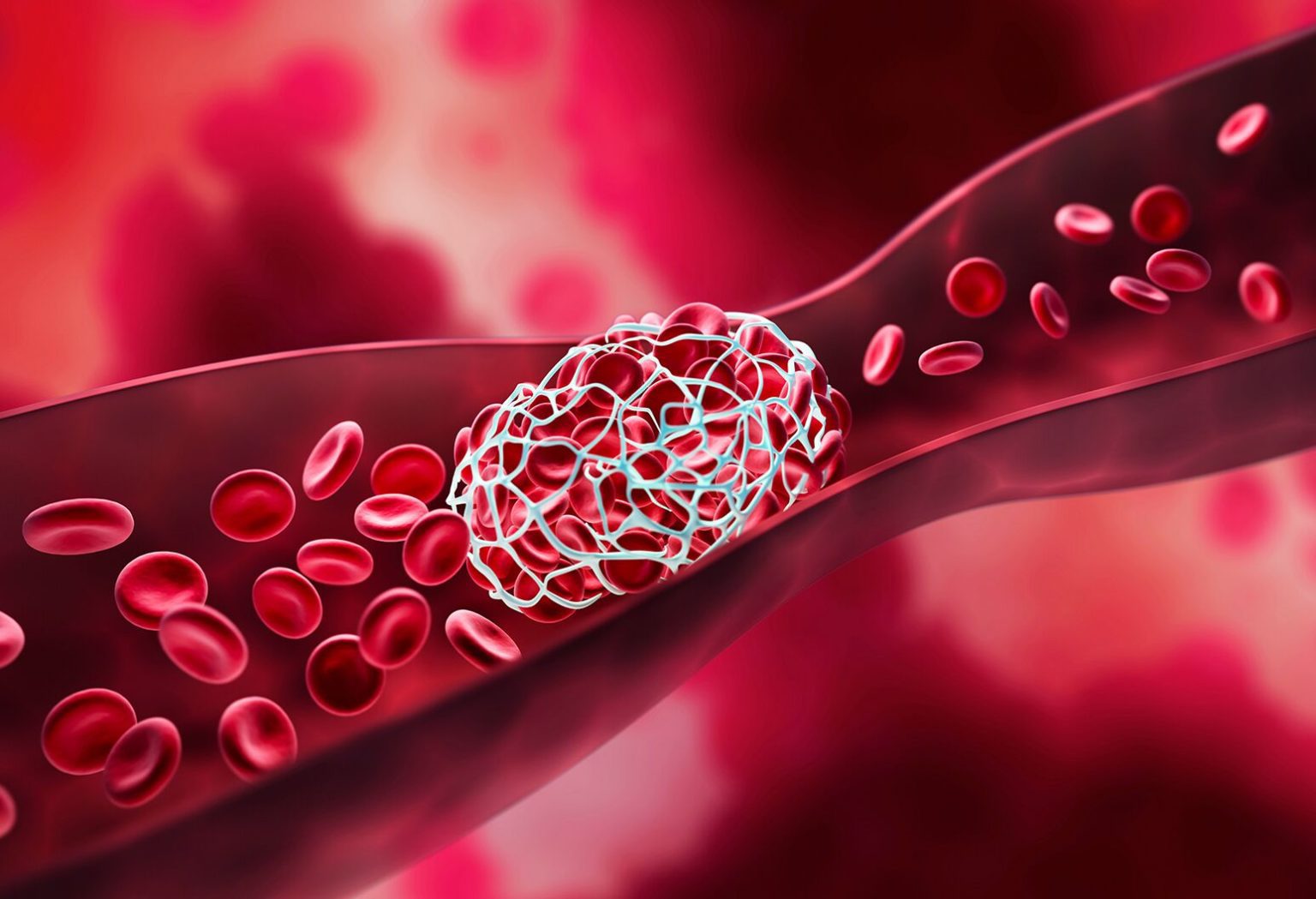 Exploring Effective Strategies for Blood Clot Prevention - World Wide ...